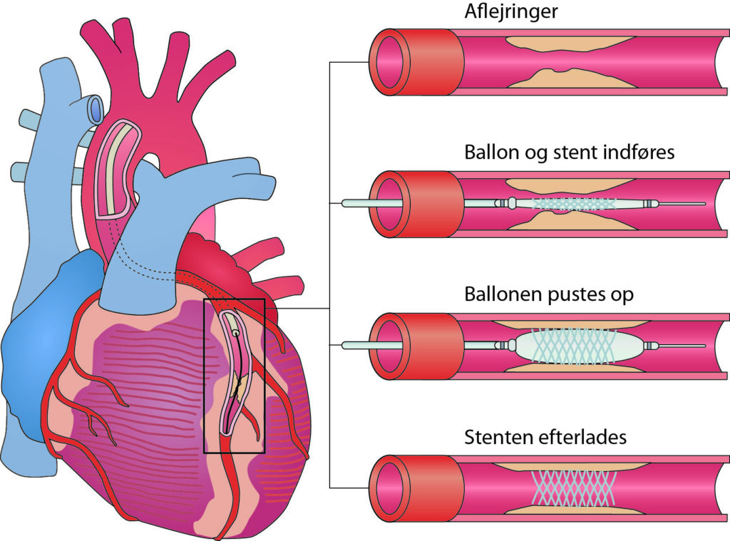 Ballonudvidelse (PCI) - Hjerteforeningen