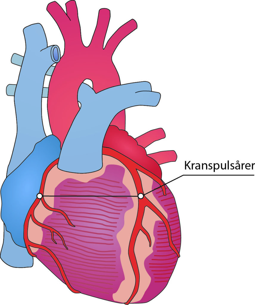 Ballonudvidelse (PCI) - Hjerteforeningen